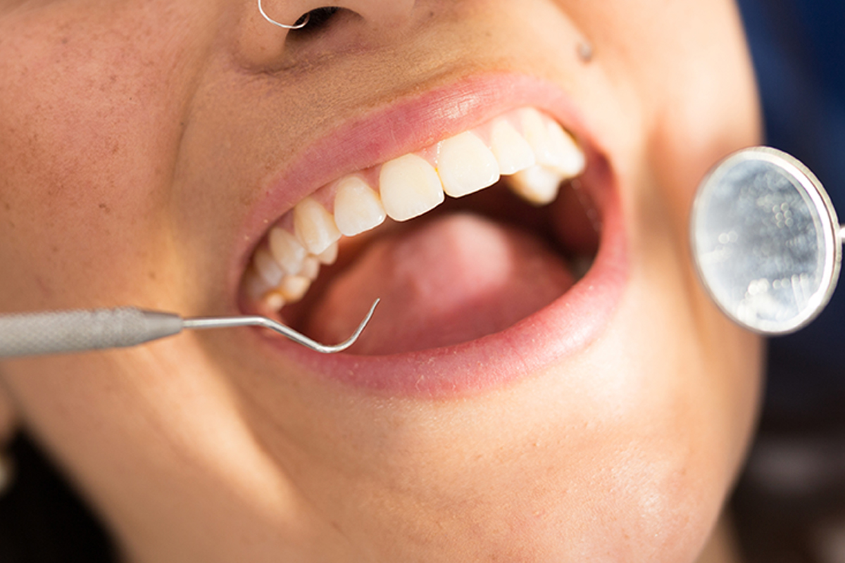 Gingivectomy in Austin, TX | Sonrisas Dental Center